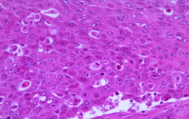 Cáncer vesical de células escamosas: reporte de un caso y revisión de ...