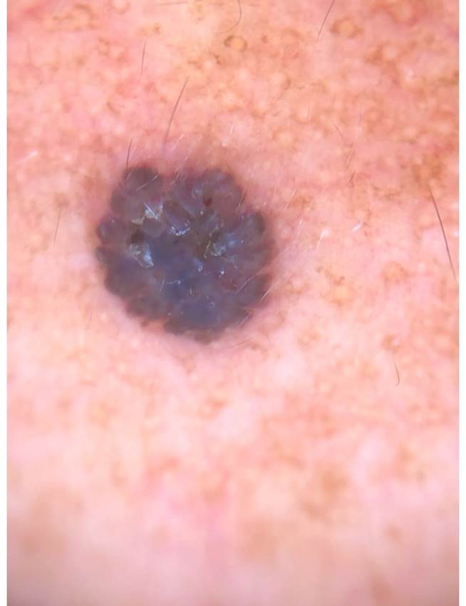 Lesiones por virus del papiloma humano en pacientes urológicos