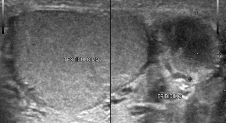 Tuberculosis testicular, presentación de un caso y revisión de la ...