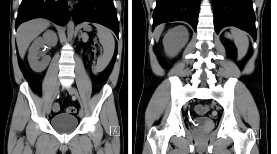 Síndrome de Zinner: revisión actualizada de la literatura basada en un ...