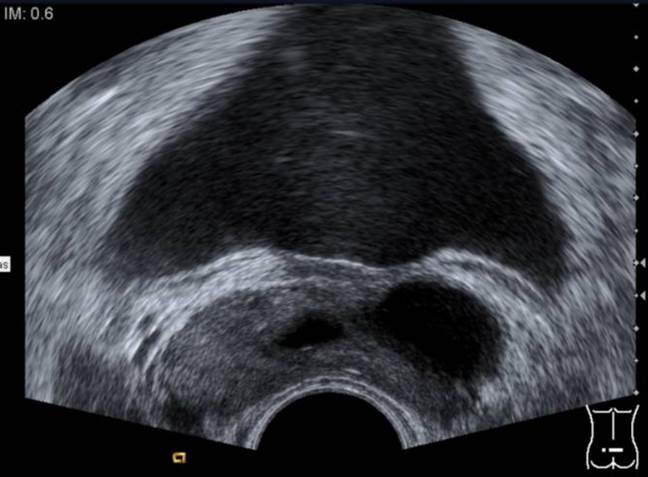 Síndrome de Zinner: revisión actualizada de la literatura basada en un ...