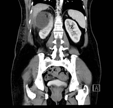 Quiste Renal Infectado: Reporte de Caso
