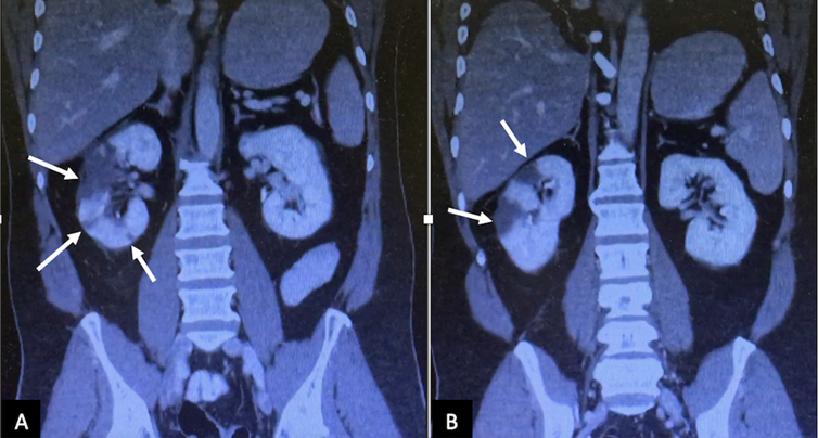 Kidney infarction in patient with covid-19: clinical case
