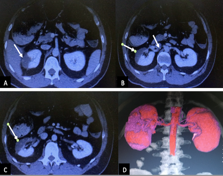 Kidney infarction in patient with covid-19: clinical case