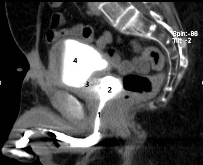 Prostatectomía total robot asistida como tratamiento para el ...