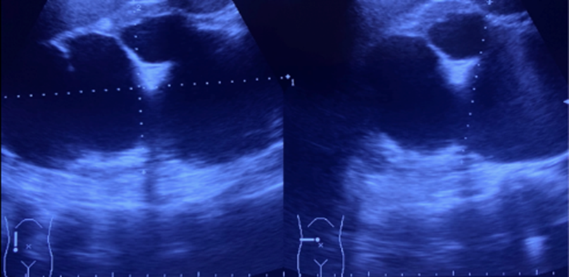 Litiasis ureteral bilateral en un paciente con hiperparatiroidismo primario