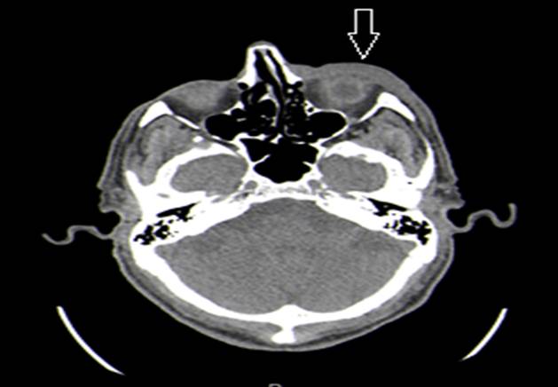 Afectación metastásica de la orbitaria por carcinoma de vejiga ...