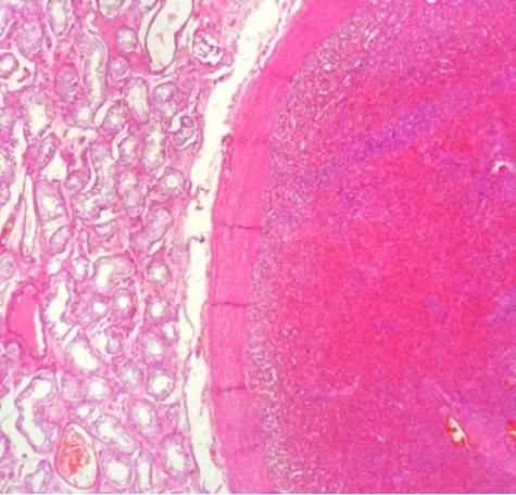 Ectopic spleen in testicular parenchyma: case report