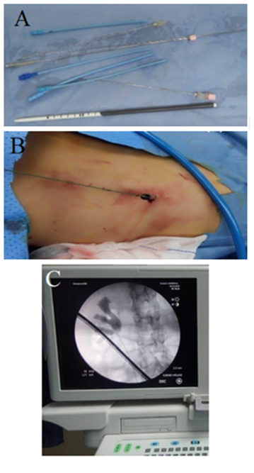 Outcomes of (chinese) mini-percutaneous nephrolithotomy for renal ...