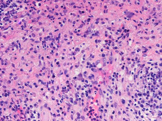 Malacoplakia of the urinary bladder: case report and systematic review