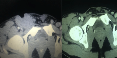 Metástasis inguinal de cáncer testicular. Reporte de dos casos