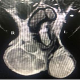 Synchronous Primary Testicular Tumor: a case report of diffuse large B ...