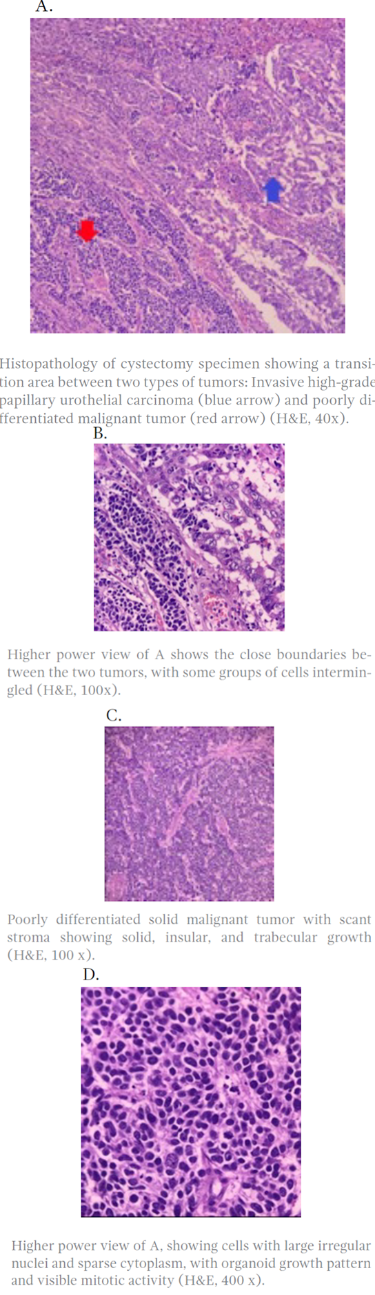 A case report of MiNEN: concomitant primary small-cell neuroendocrine ...