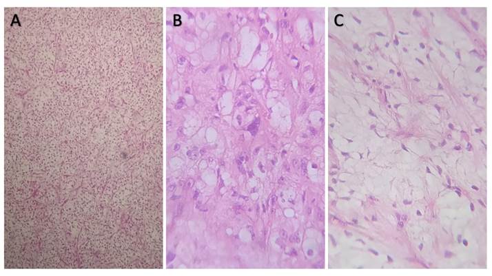 Liposarcoma mixoide paratesticular metastásico a sistema nervioso ...