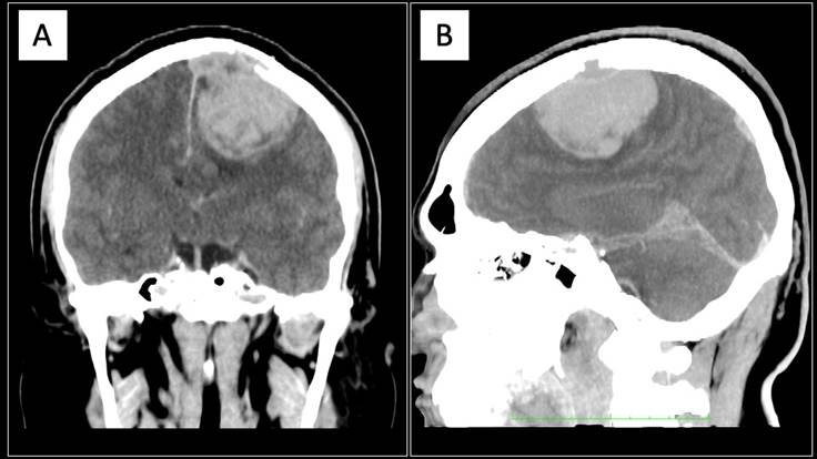 Liposarcoma mixoide paratesticular metastásico a sistema nervioso ...