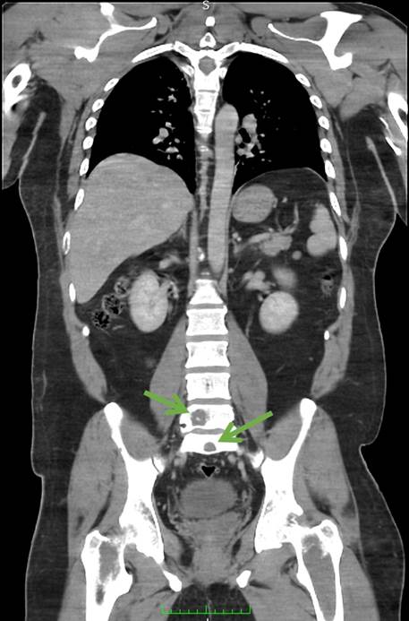 Liposarcoma mixoide paratesticular metastásico a sistema nervioso ...