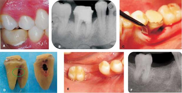 Terapia periodontal en un paciente con periodontitis agresiva