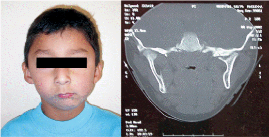 Evaluación y manejo de las fracturas de cóndilo mandibular en pacientes ...