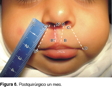 Análisis funcional y estético de labioplastia primaria mediante la ...