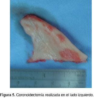 Tratamiento con artroplastia de anquilosis de la articulación ...