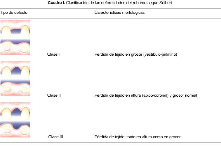 Aumento del reborde alveolar por medio de injertos autólogos de tejido ...