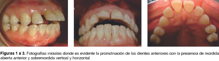 Corticotomía: Microcirugía ortodóntica en paciente con periodonto ...