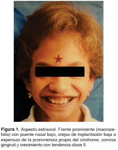 Aspectos estomatológicos en el síndrome del X frágil: Revisión de la ...