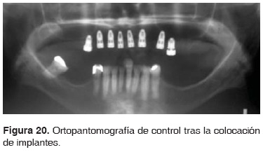 Reconstrucción de proceso alveolar maxilar con injerto autólogo de ...