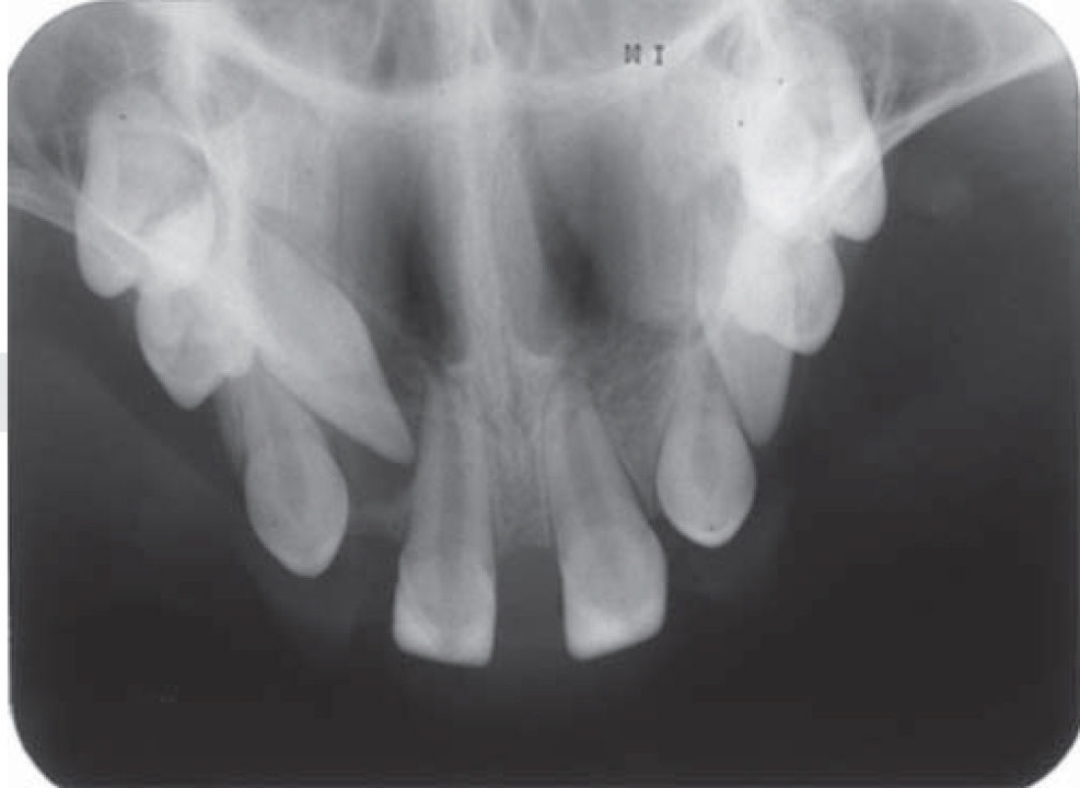 Dentes Com Displasia Ectodermica Hipoidrotica 294x222