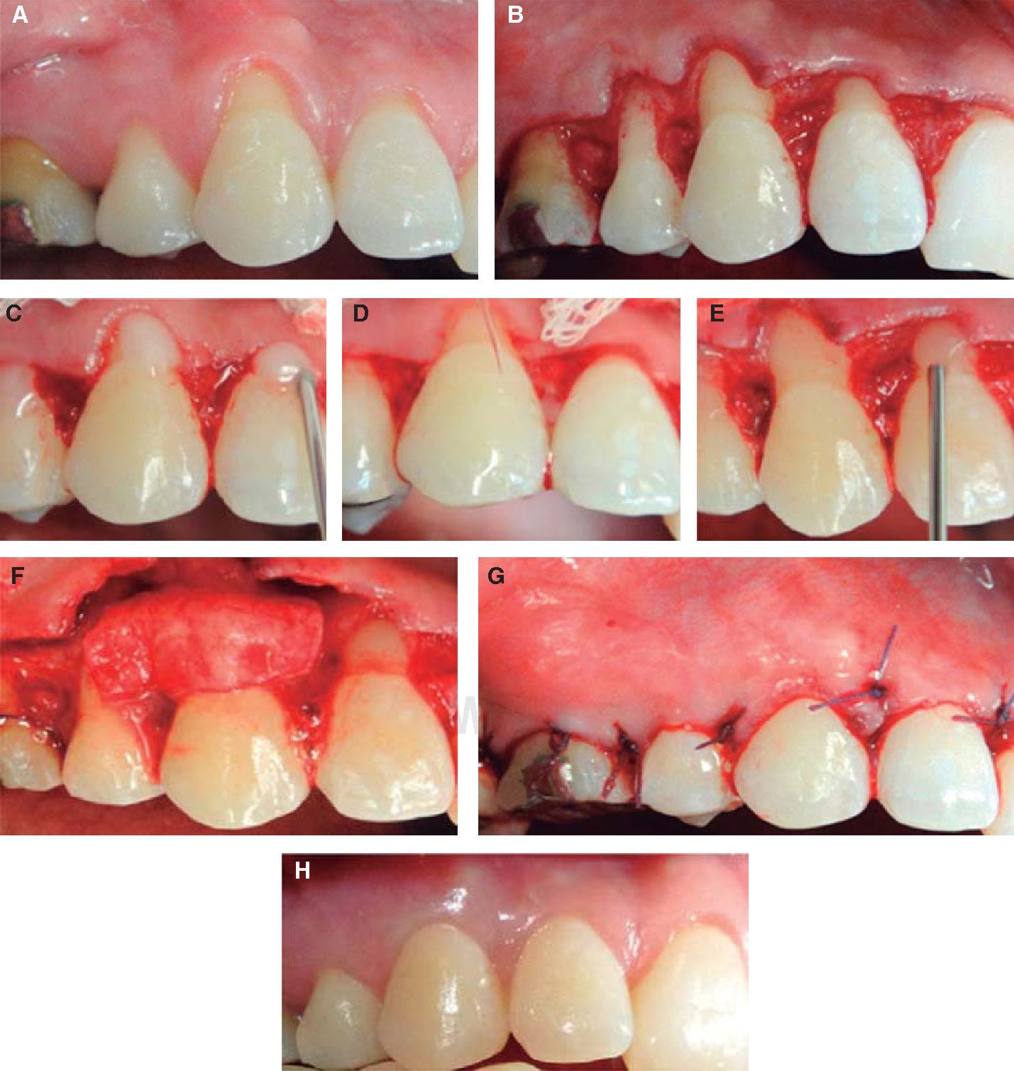 Comparación clínica del uso del colgajo de avance coronal e injerto de ...