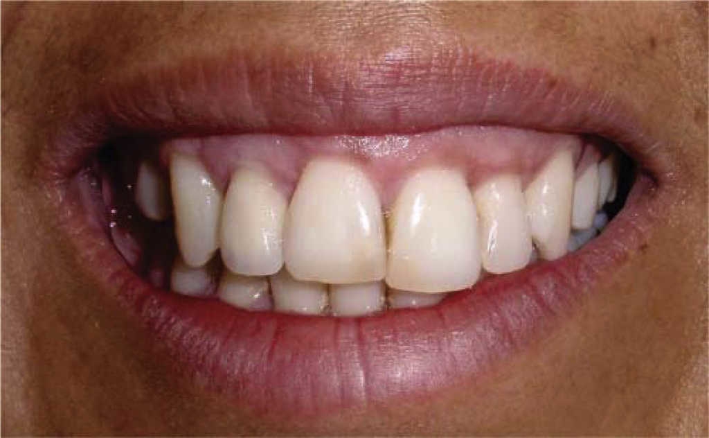 Reimplantación, anquilosis y sustitución con implante. Presentación de ...