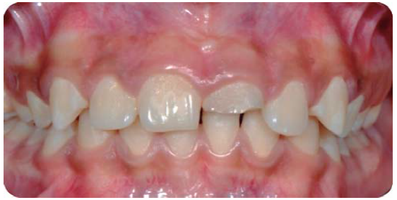 Tratamiento restaurador de lesiones dentales traumáticas. Reporte de ...