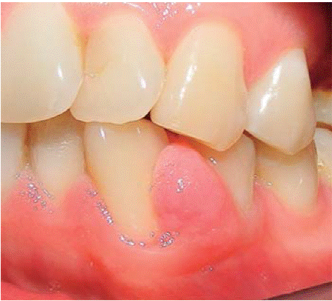 Diagnóstico y tratamiento del granuloma piógeno oral: serie de casos