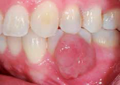 Granulation Tissue Mouth