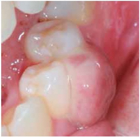 Granulation Tissue Mouth