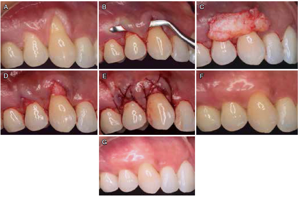 Clasificación De La Recesión Gingival