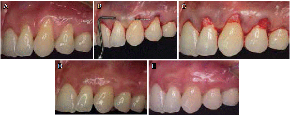 Clasificación De La Recesión Gingival