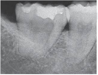 Presencia del cuarto molar. Revisión de la literatura