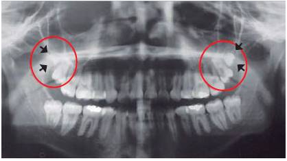 Presencia del cuarto molar. Revisión de la literatura