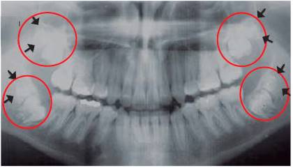 Presencia del cuarto molar. Revisión de la literatura