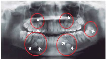 Presencia del cuarto molar. Revisión de la literatura