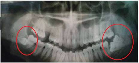 Presencia del cuarto molar. Revisión de la literatura