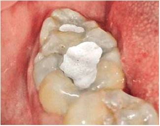 Presencia del cuarto molar. Revisión de la literatura