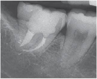 Presencia del cuarto molar. Revisión de la literatura