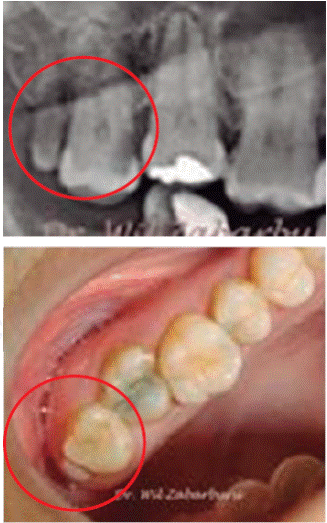 Presence of the fourth molar. Literature review