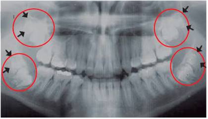Presence of the fourth molar. Literature review