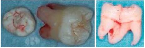 Presencia del cuarto molar. Revisión de la literatura