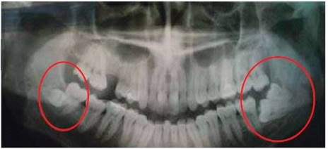 Presence of the fourth molar. Literature review