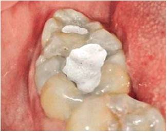 Presence of the fourth molar. Literature review