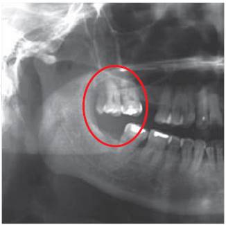 Presencia del cuarto molar. Revisión de la literatura